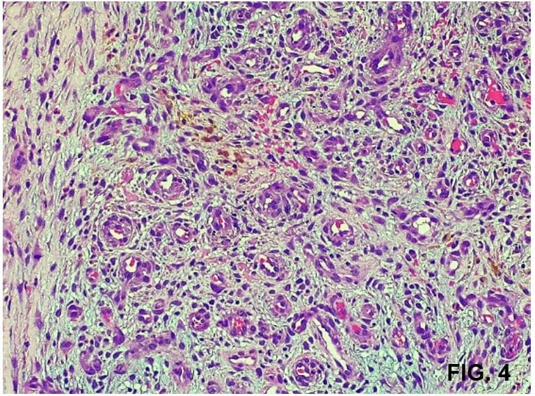 Agroangiodermatitis o Pseudosarcoma de Kaposi tipo Mali : Revista ...